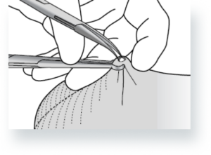 Safe, Effective Non-Scalpel Vasectomy | The Cooper Clinic